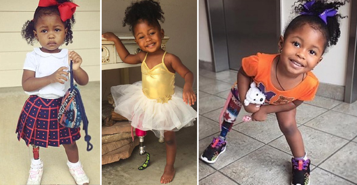 Two-year-old who had her leg amputated inspires millions all over the ...